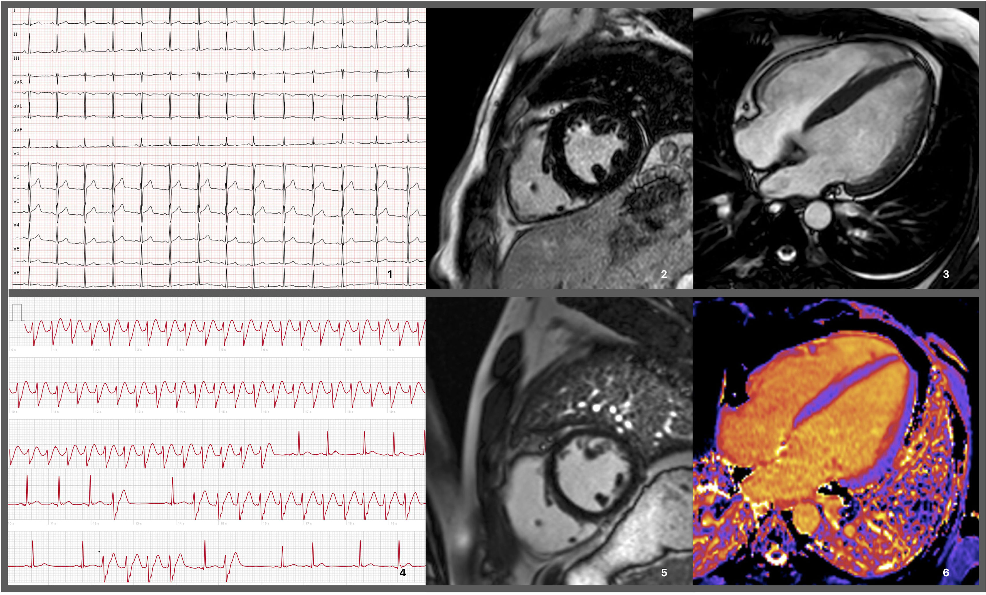 Left ventricular cardiomyopathy due to CPT II hereditary deficiency ...
