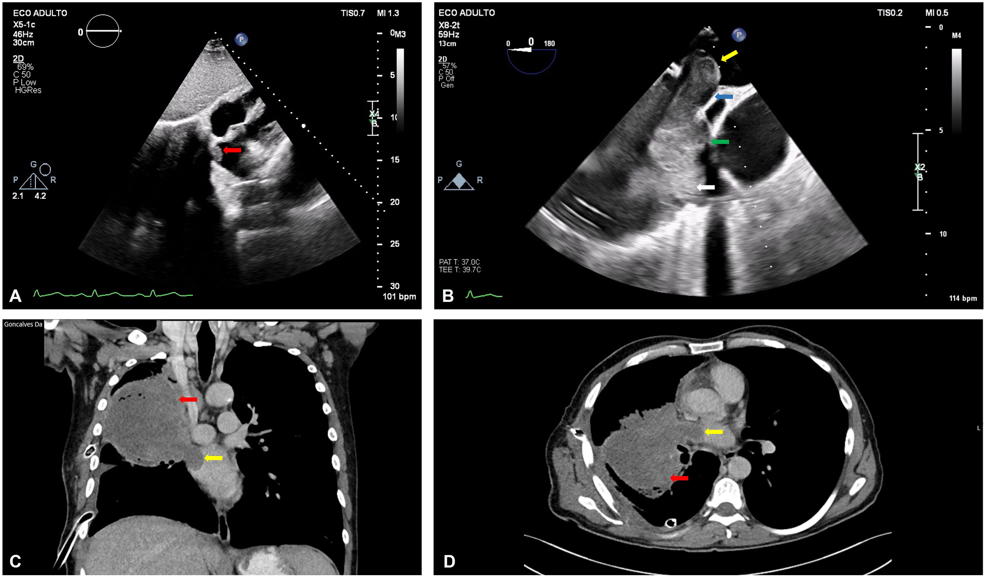 Lung adenocarcinoma: The diagnostic importance of echocardiography ...