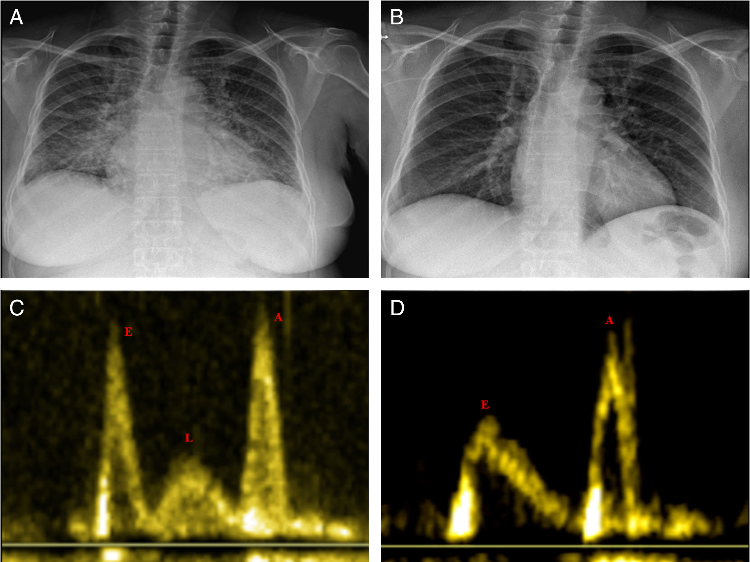 Acute L waves in heart failure | Revista Portuguesa de Cardiologia