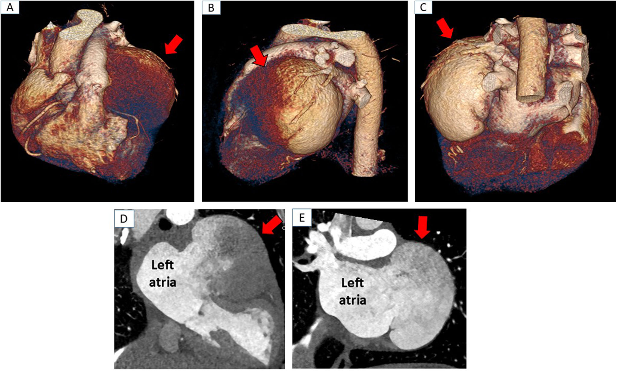 Left atrial appendage aneurysm: An unexpected finding in a patient with ...