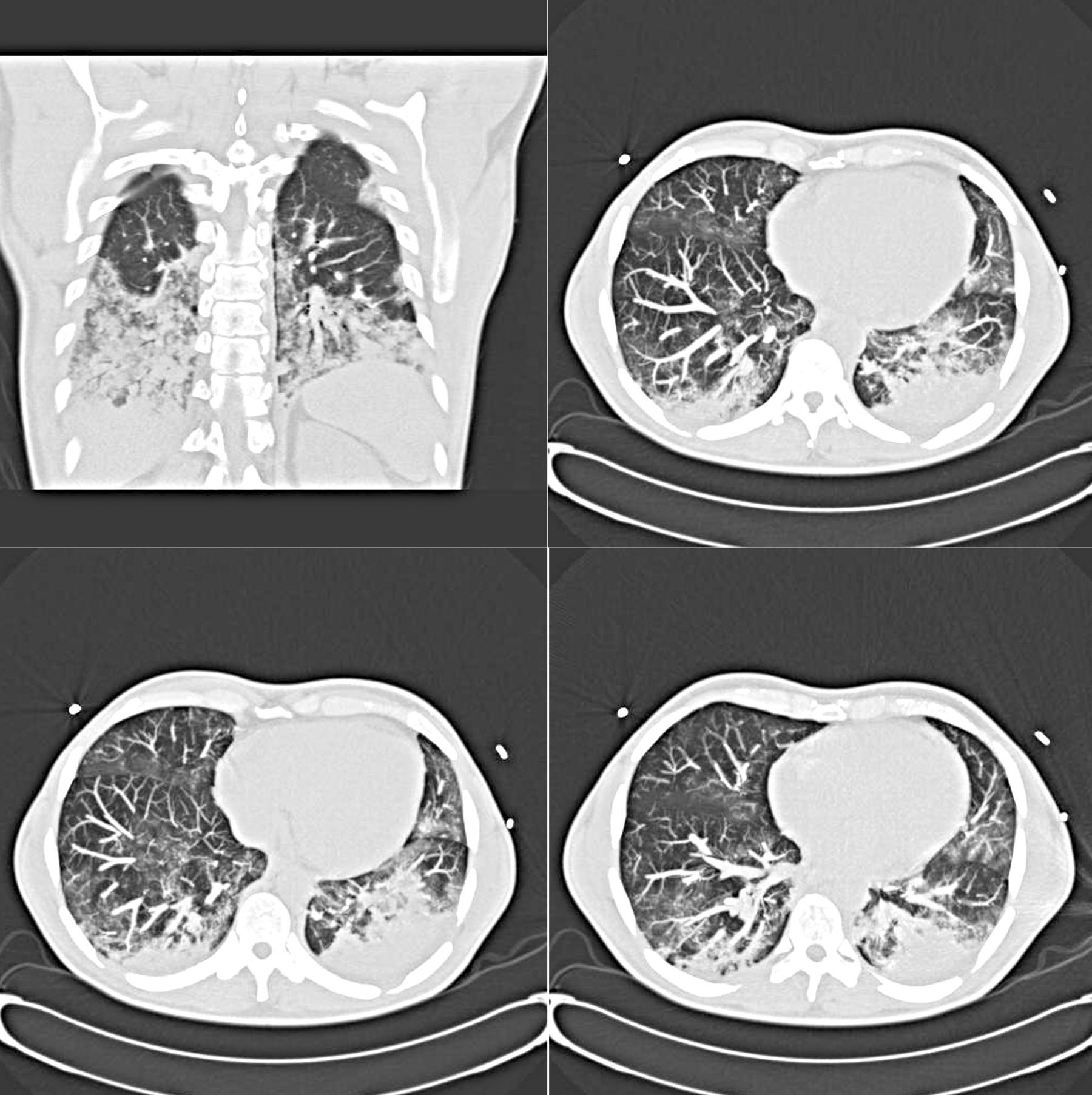 Chest radiological findings of influenza A H1N1 pneumonia | Pulmonology