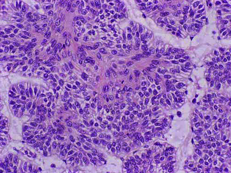 Malignant eccrine spiradenoma of the nasolabial fold. A case report ...