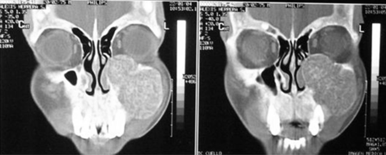 Tumor pardo maxilar refractario a tratamiento convencional | Revista ...