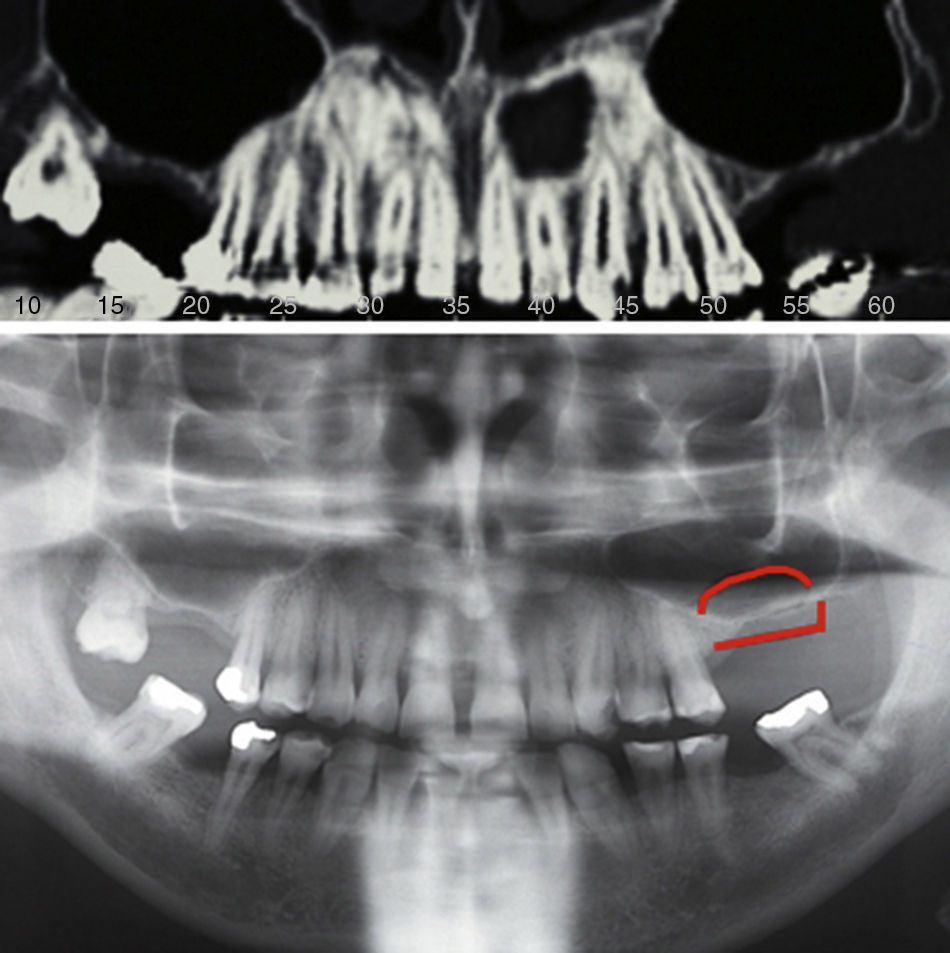 Tratamiento del maxilar posterior atrófico mediante técnica de ...
