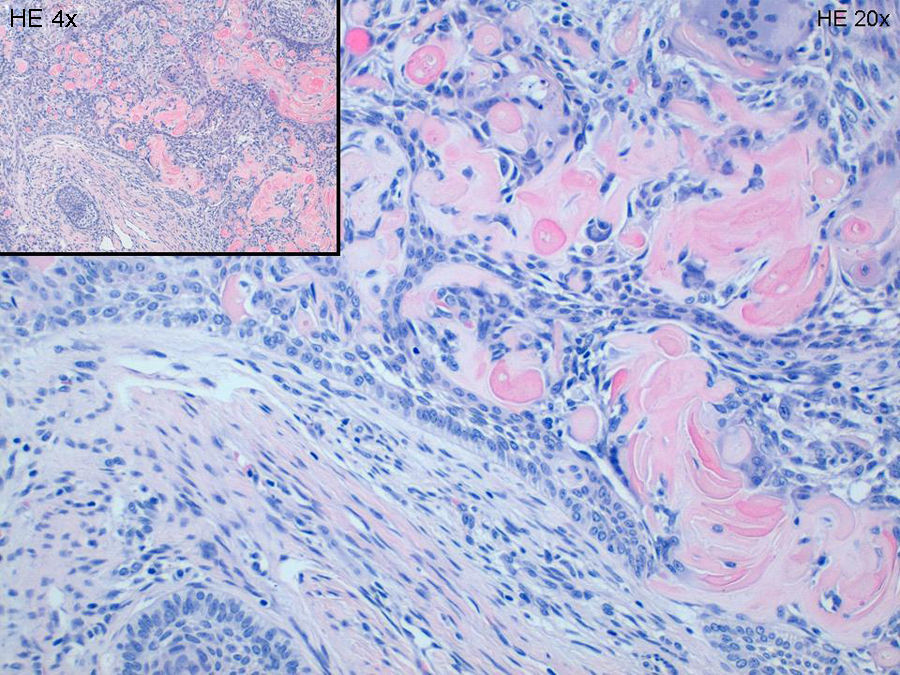ghost cell calcification