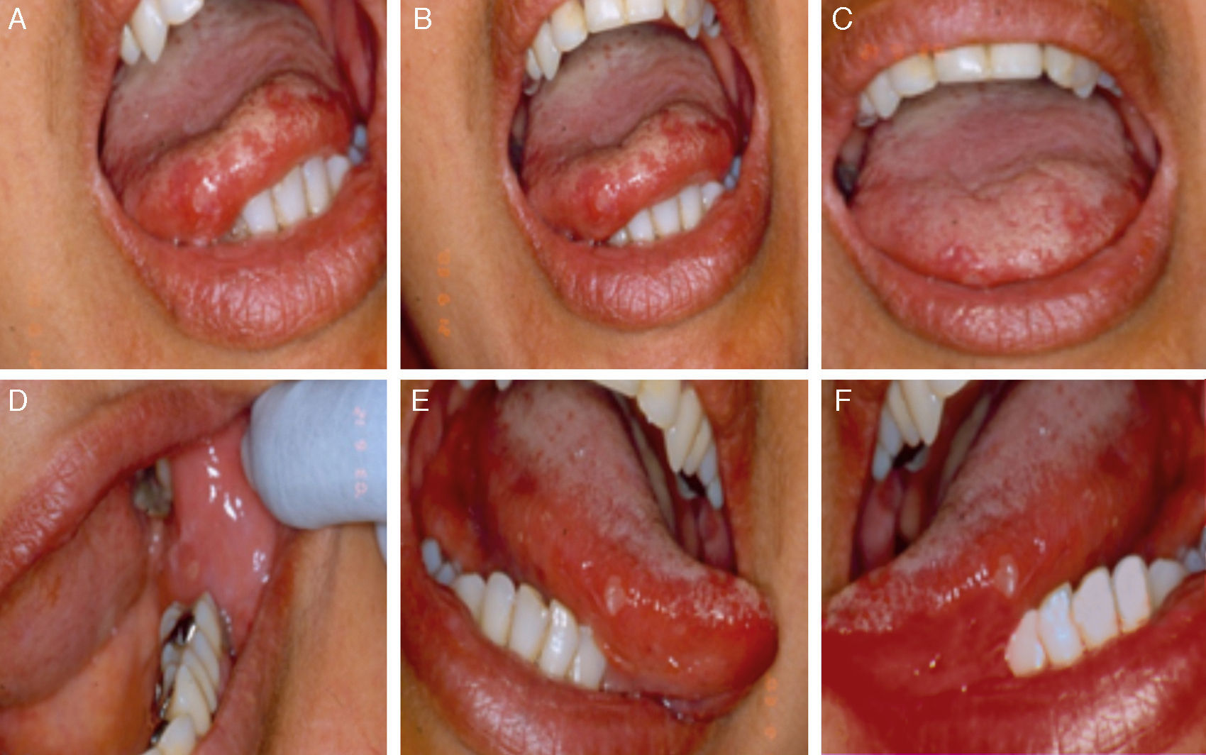 multiple tongue ulcers