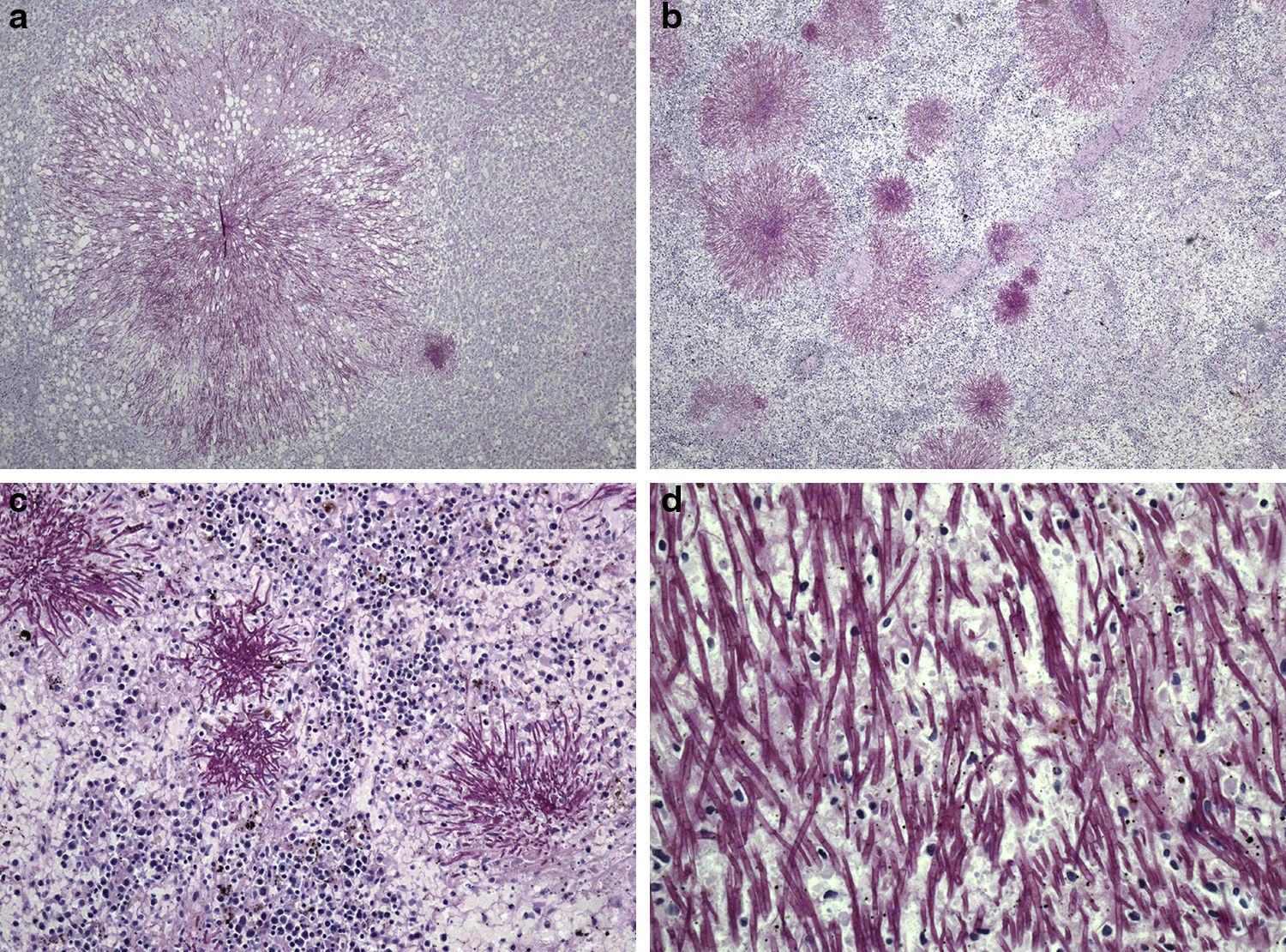 Invasive infections caused by Saprochaete capitata in patients with ...