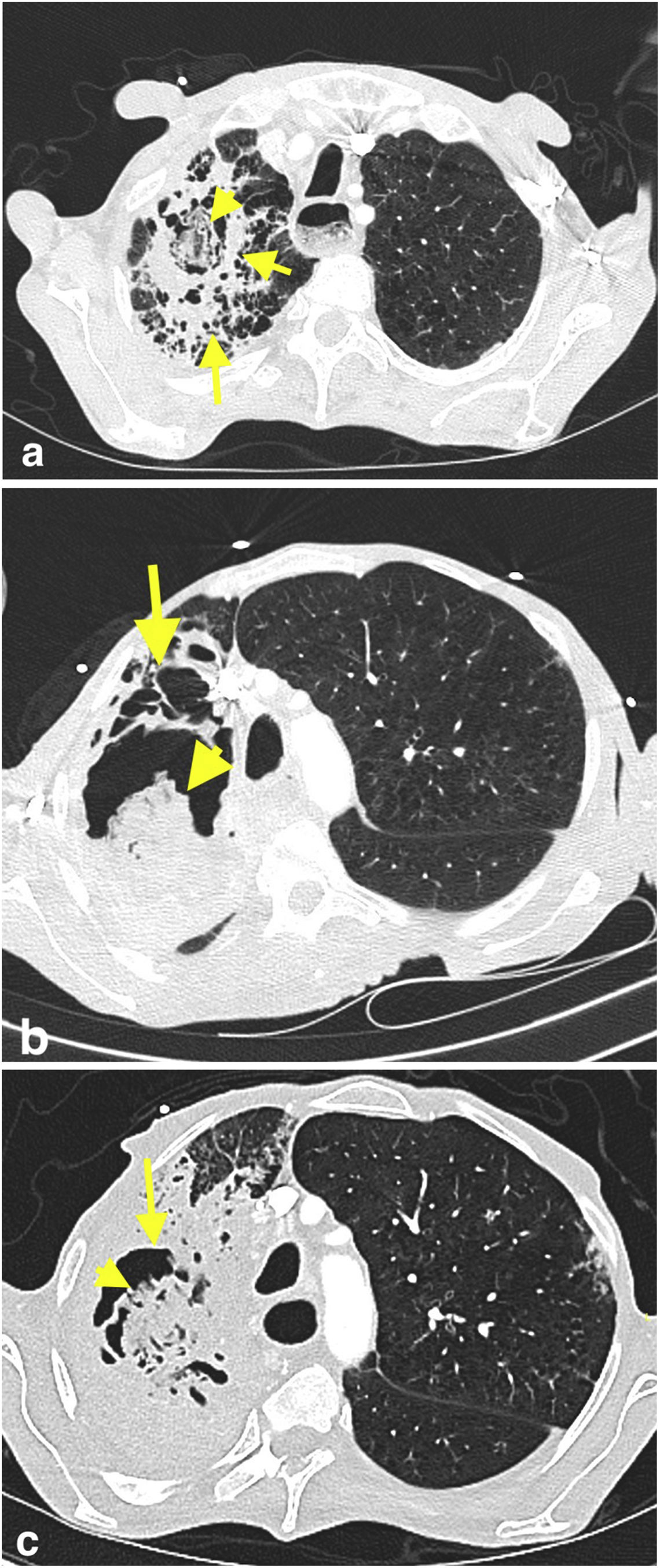 necrotizing pneumonia bronchoscopy
