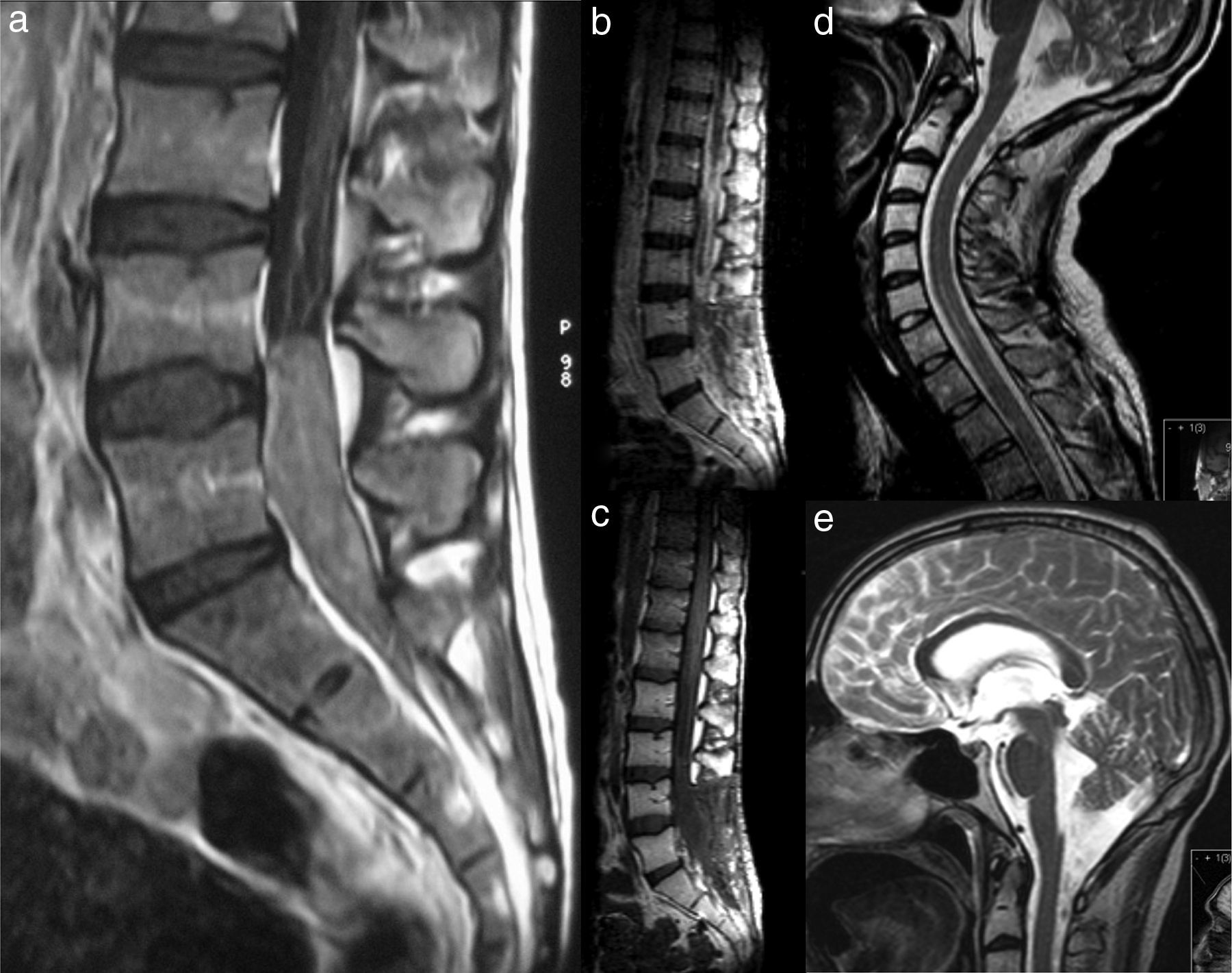 Epithelioid sarcoma of the spine: Case report and literature review ...