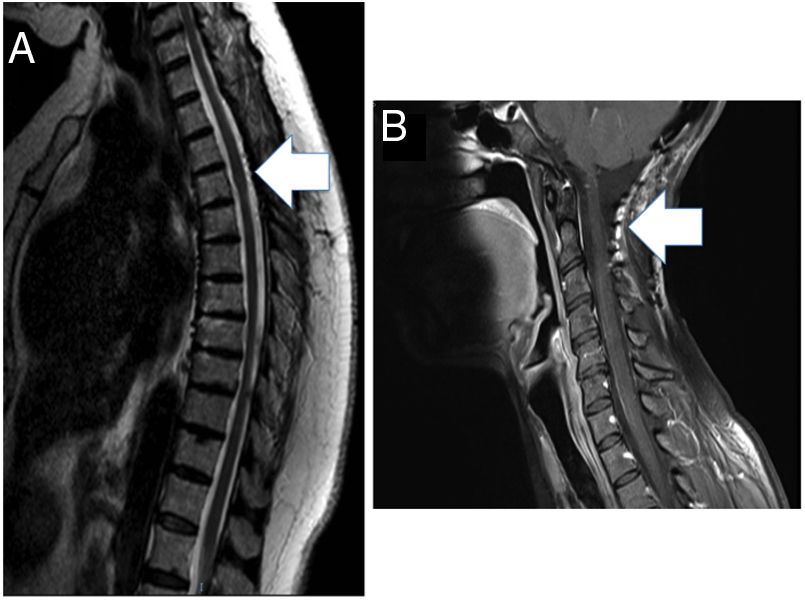 Spinal dural closure without suture: Minimizing the risk of CSF leakage ...