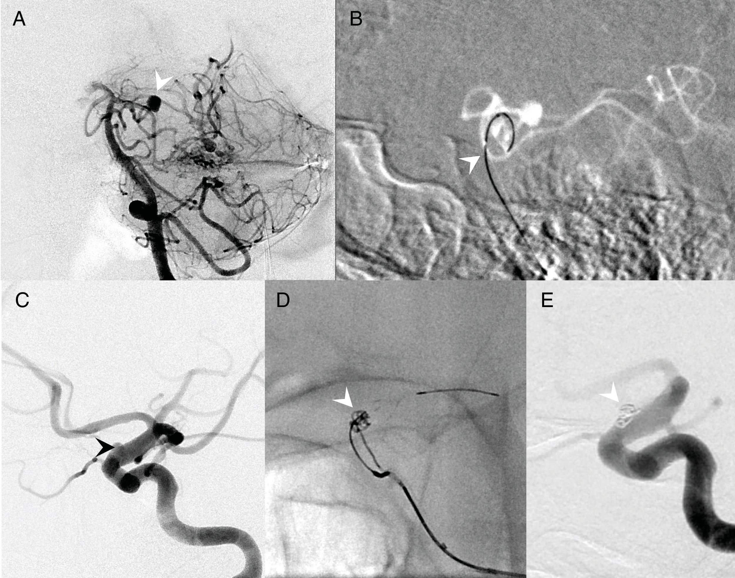 Treatment of complex intracranial pathologies with transcirculation ...