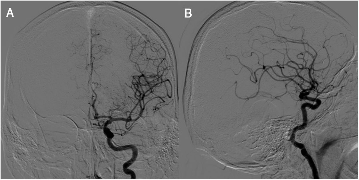 Angiographically occult and spontaneously thrombosed large brain ...