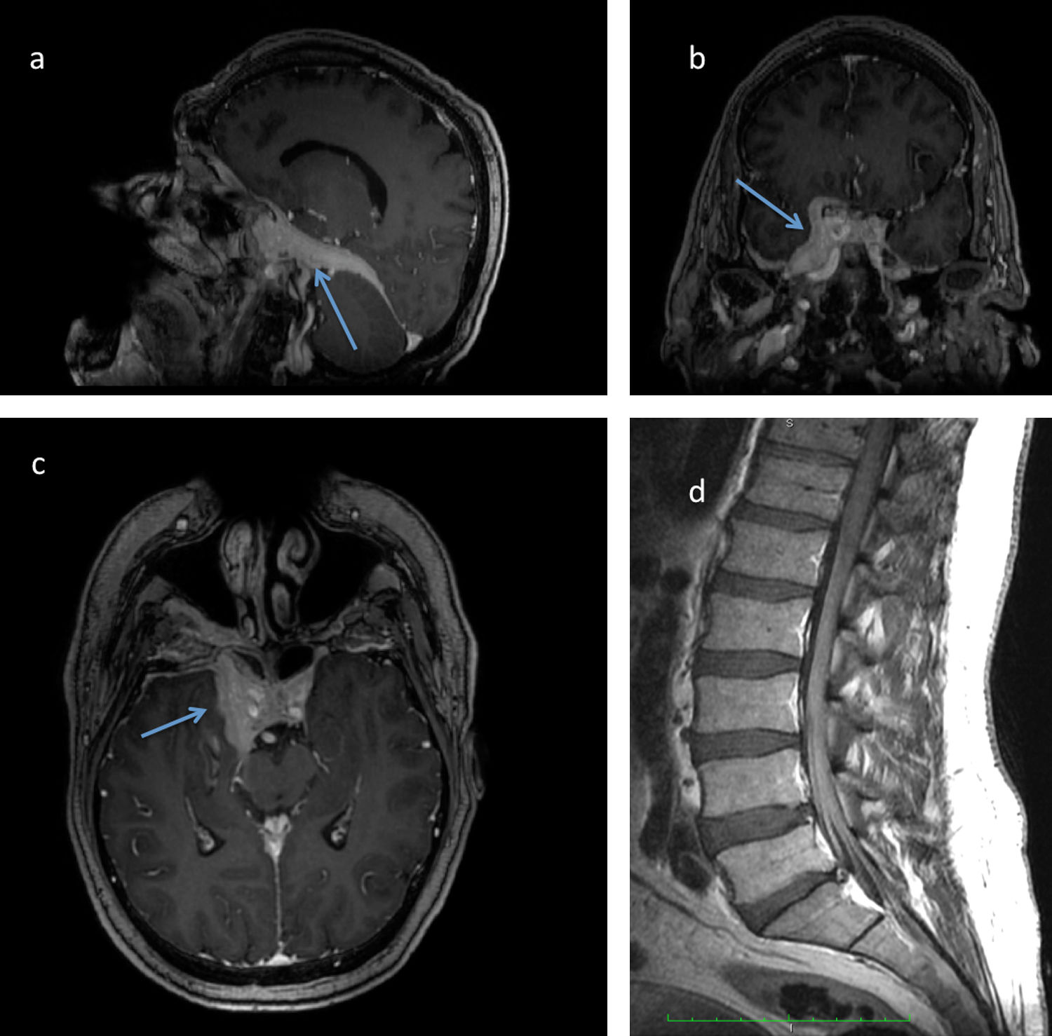Bing–Neel syndrome presenting with bilateral lumbar radiculopathy: A ...