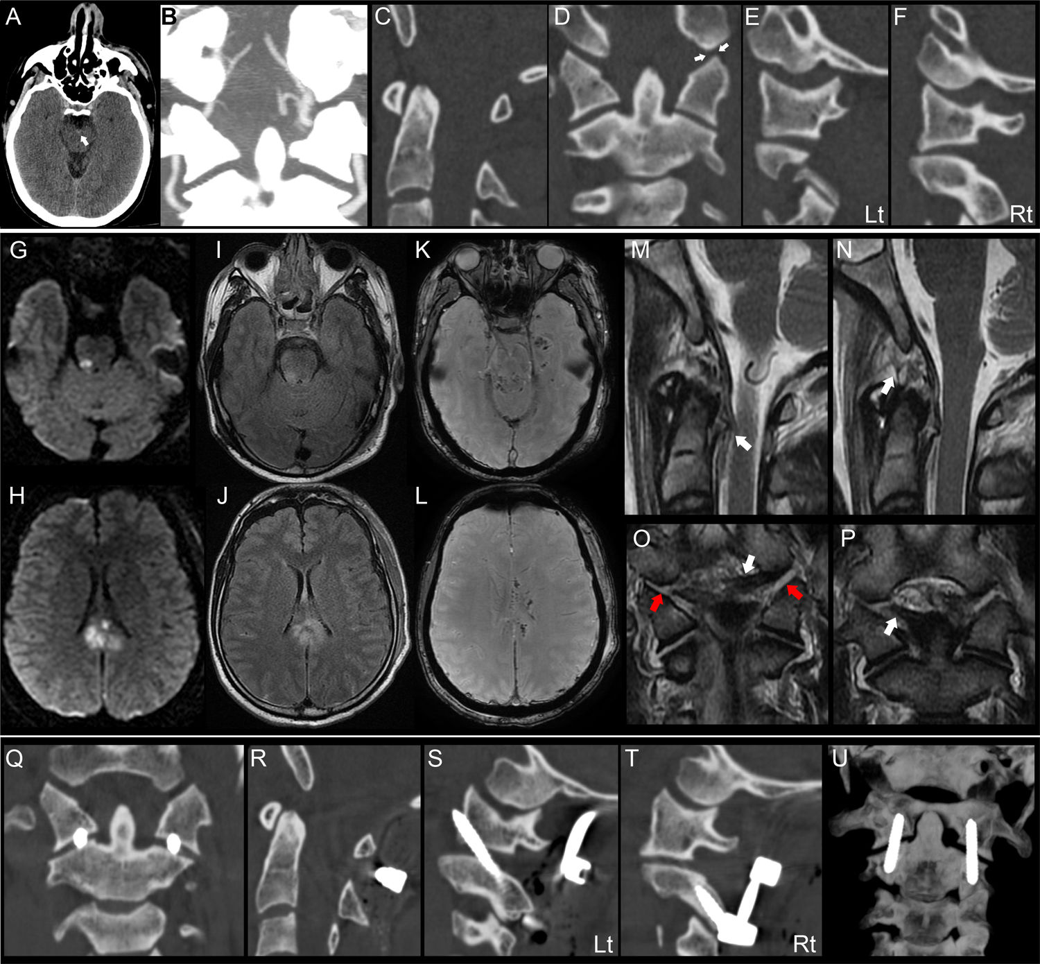 Atlanto-occipital dislocation with concomitant severe traumatic brain ...