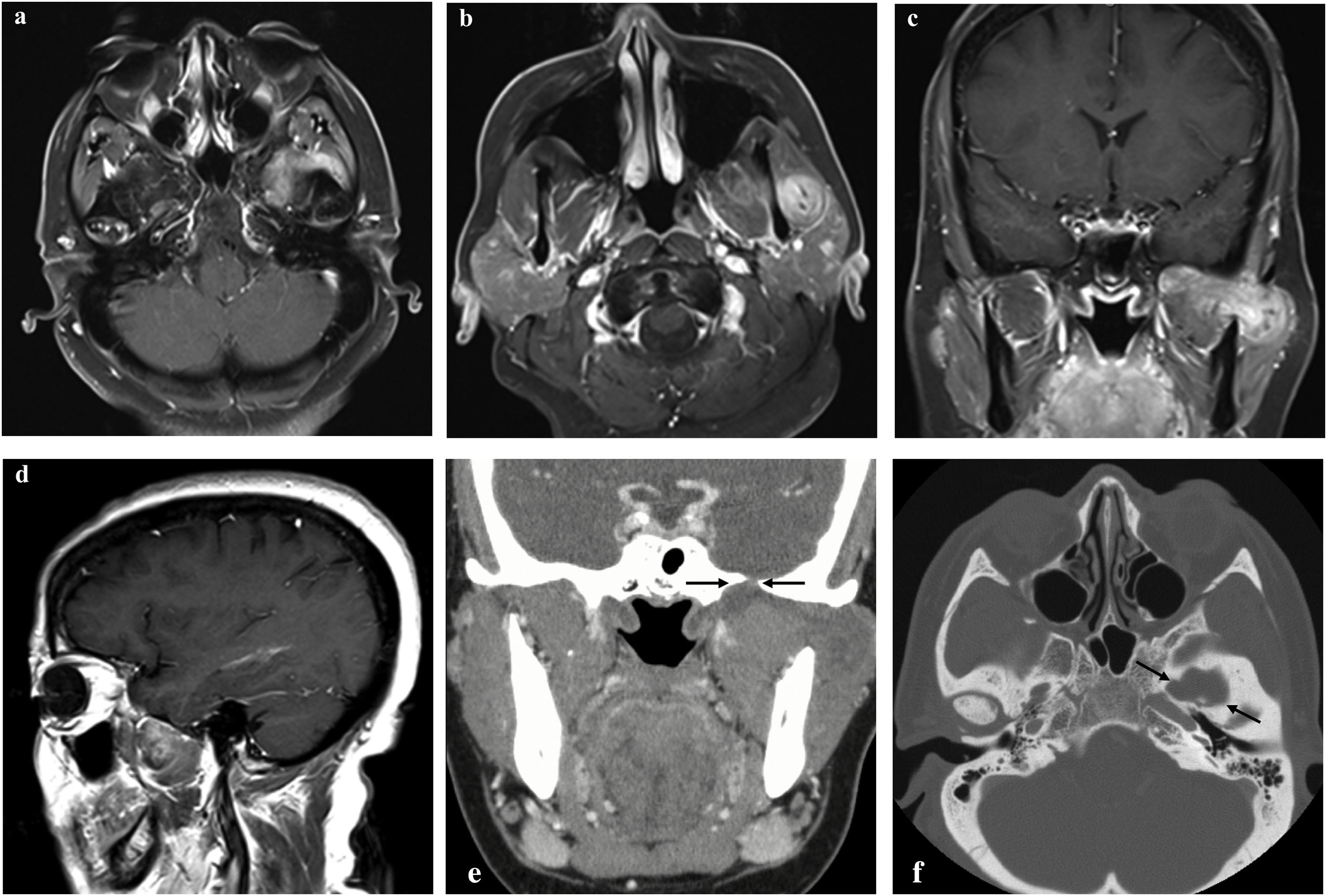 Combined endoscopic endonasal & transoral approach to transpatial ...