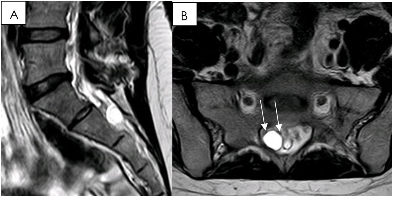 Symptomatic sacral Tarlov cyst: Case report and review of literature ...