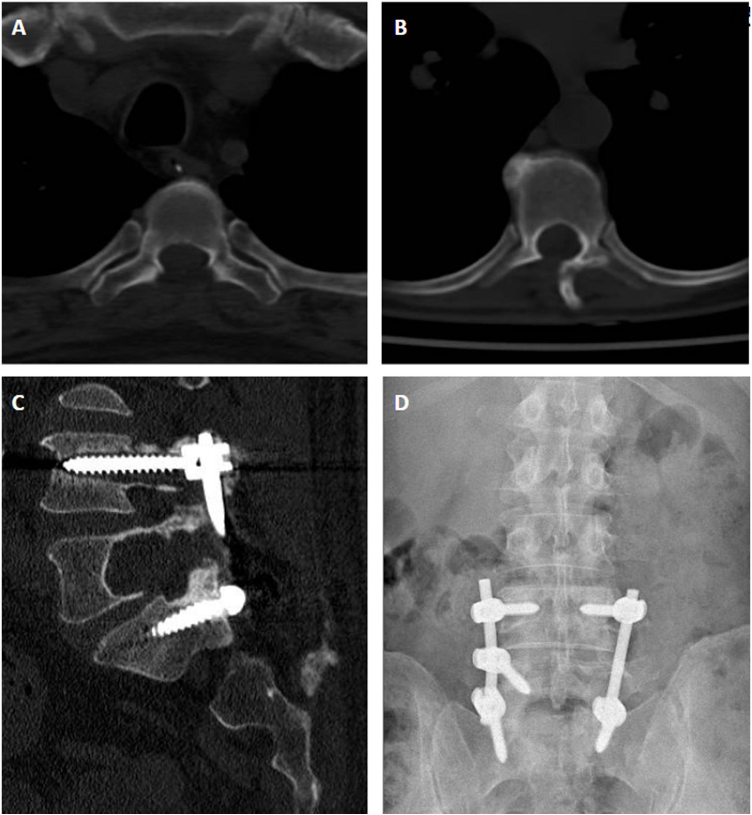 Intradural extramedullary tumors. Retrospective cohort study assessing ...
