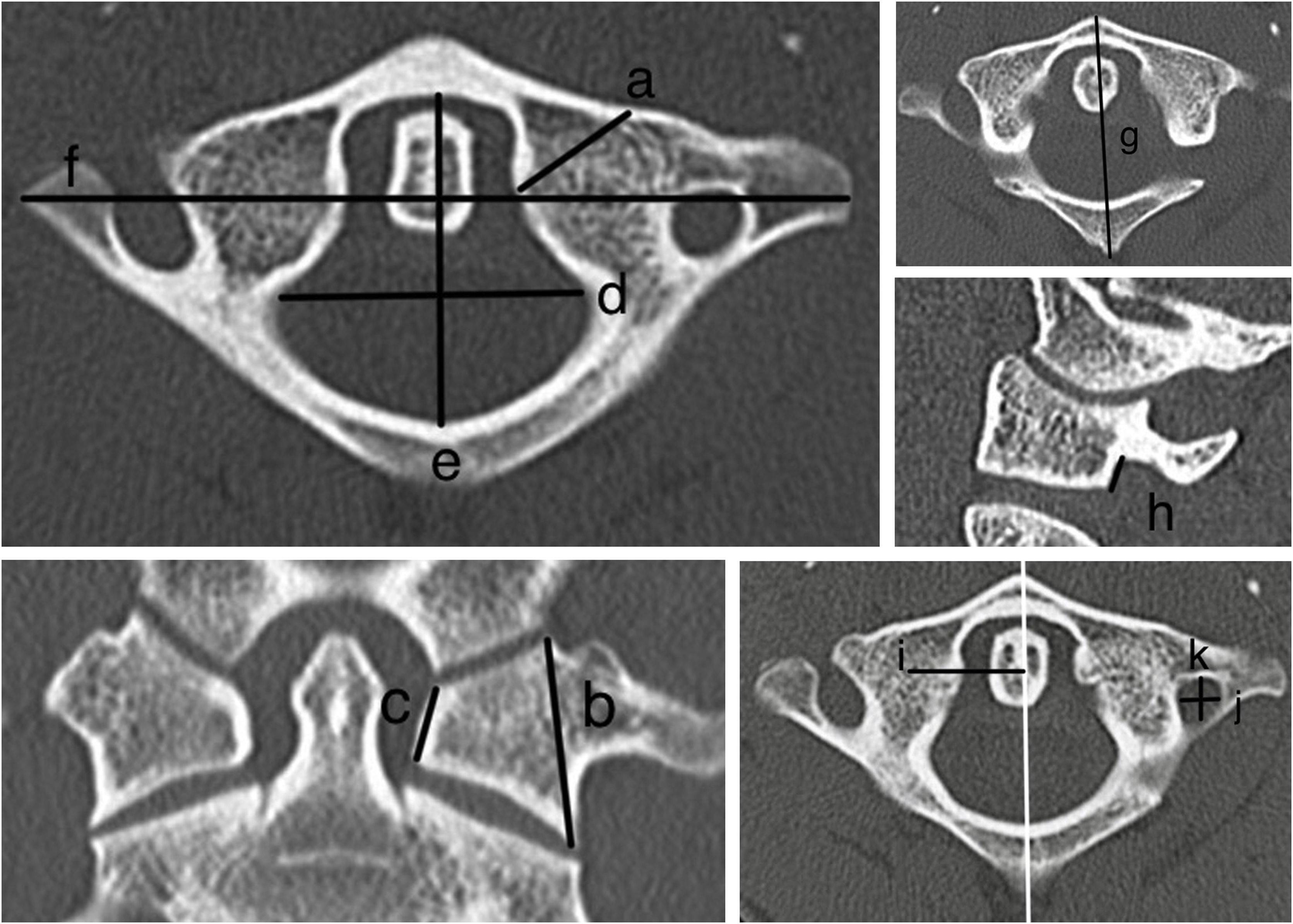 Pediatric atlas anatomy and its implications for fracture treatment: an ...