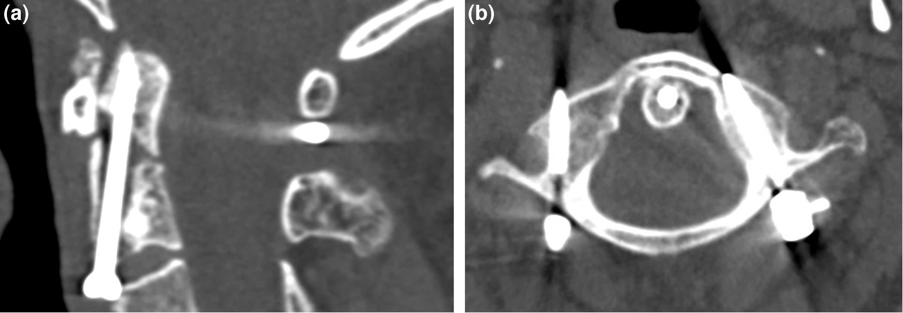 Short-term and long-term results of odontoid screw fixation in patients ...