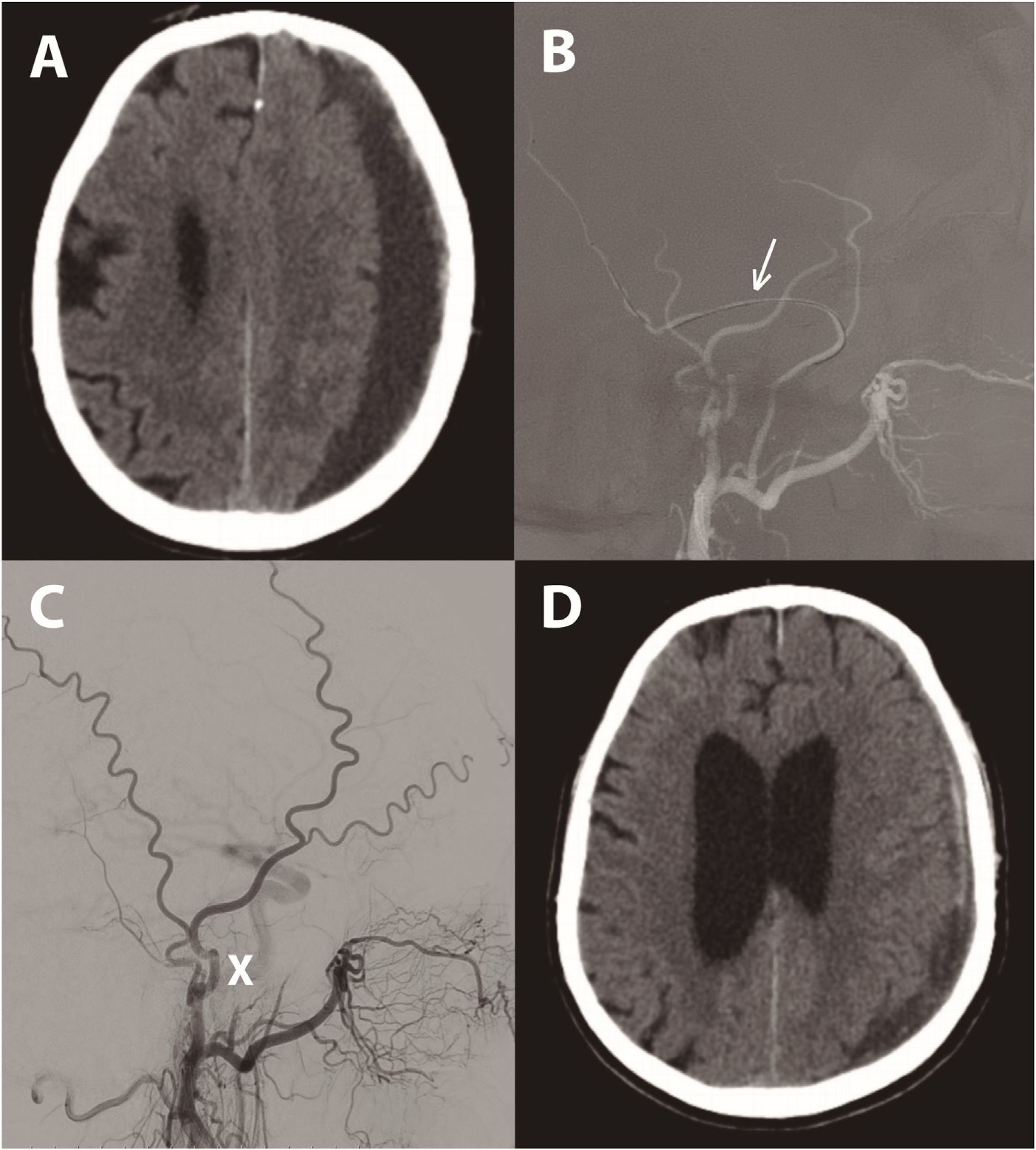 Endovascular treatment of chronic subdural hematoma in a dual-trained ...