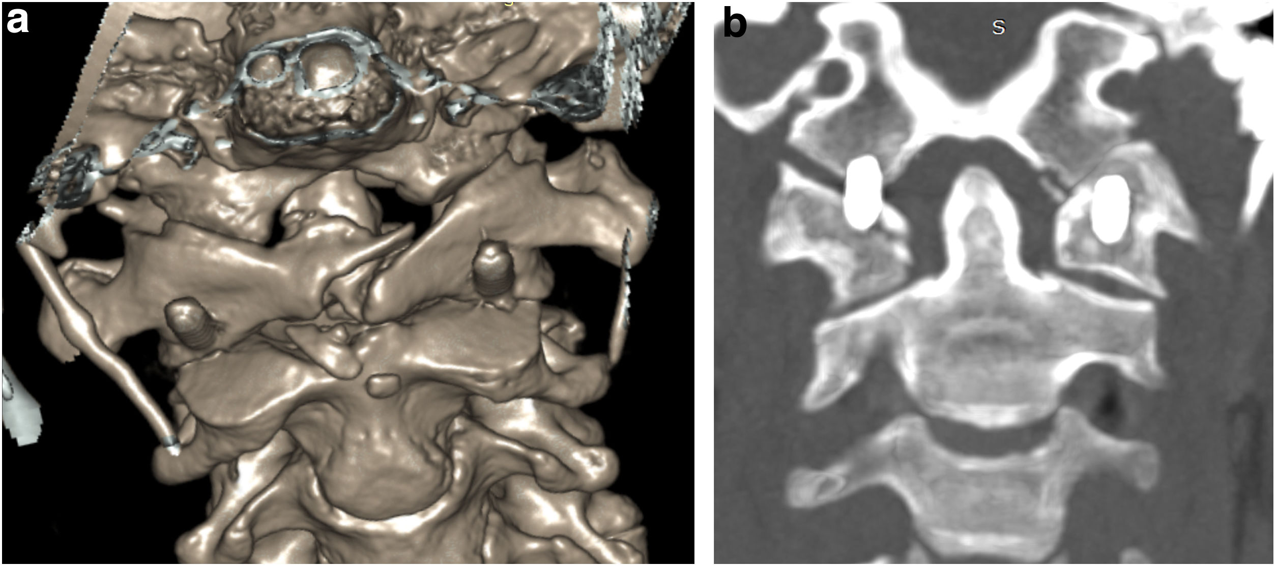 Fully percutaneous posterior transarticular C1-C2 stand-alone screw ...