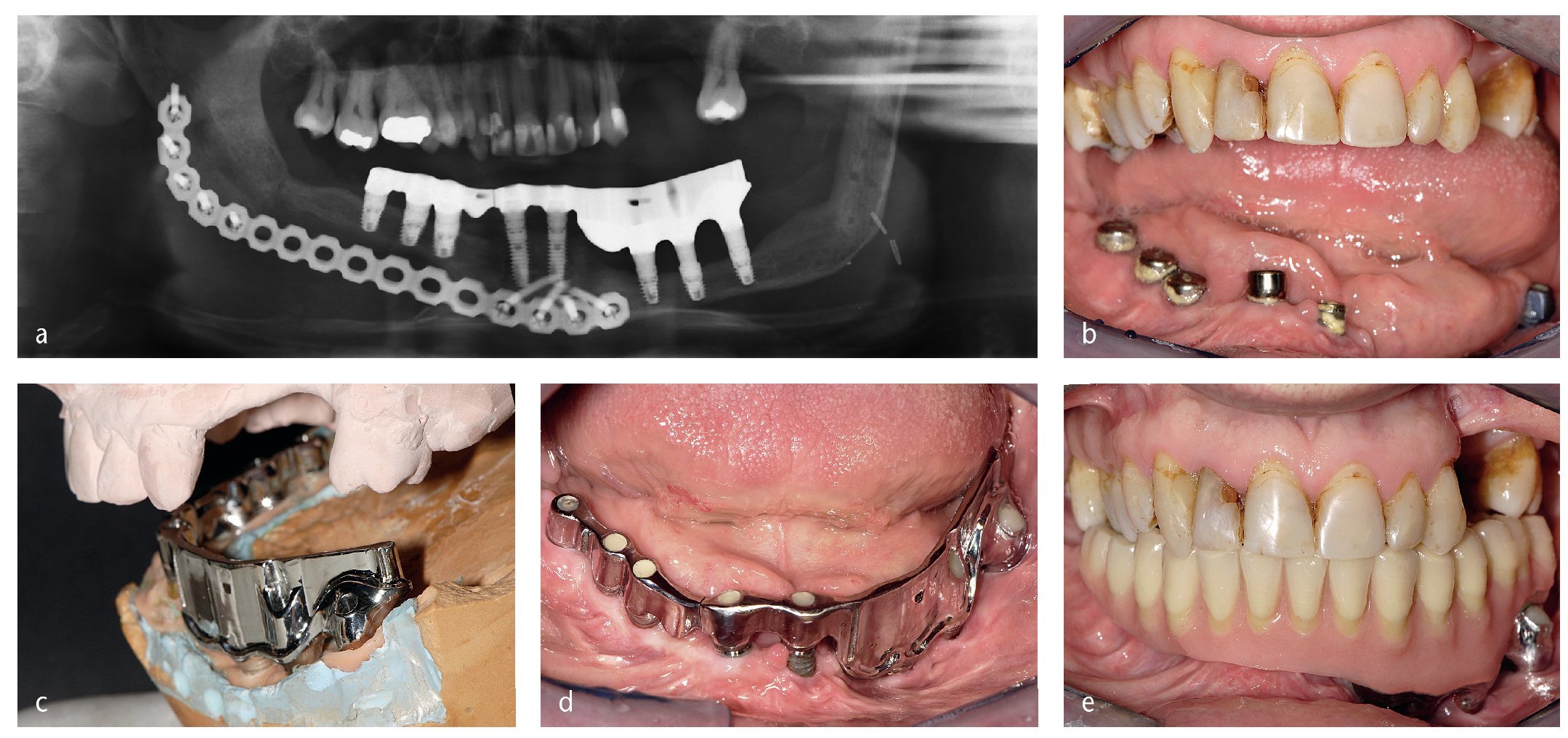 Prótesis maxilofacial con y sin implantes | Quintessence Técnica