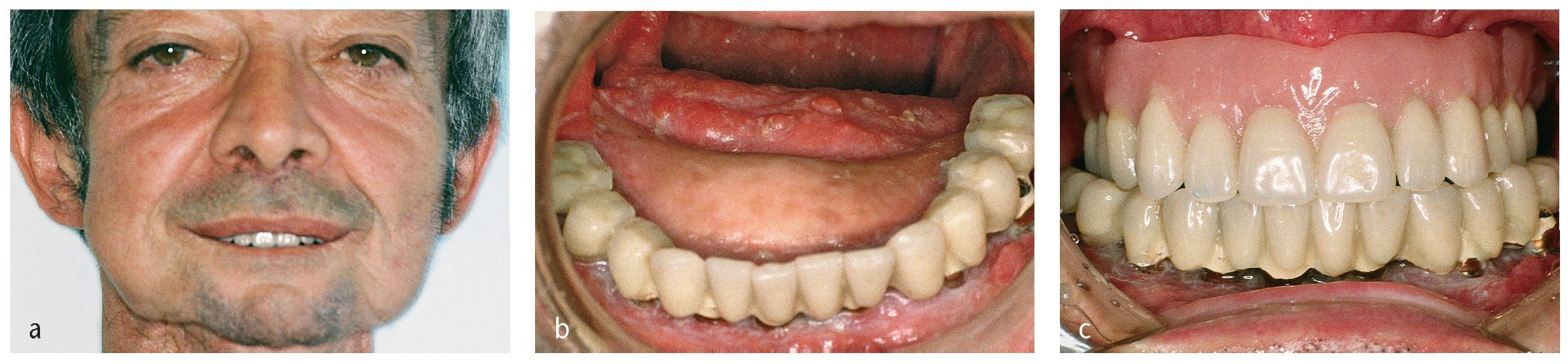 Prótesis maxilofacial con y sin implantes | Quintessence Técnica