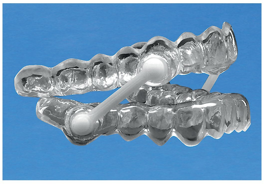 Aparatos para la medicina del sueño: un reto para la prótesis dental ...