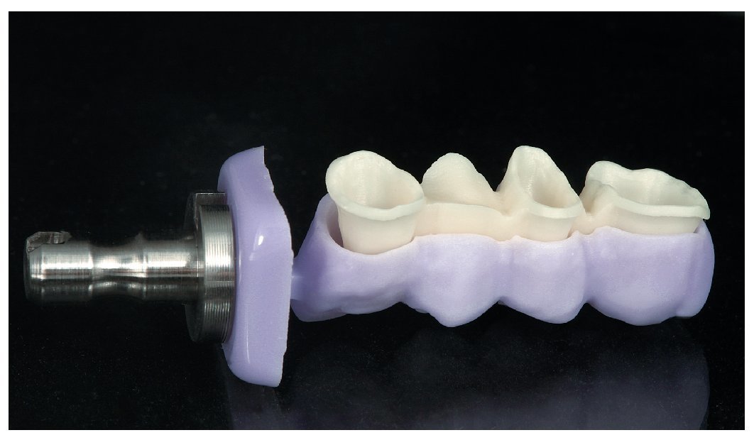 Recubrimiento digital de coronas y estructuras de puentes ...