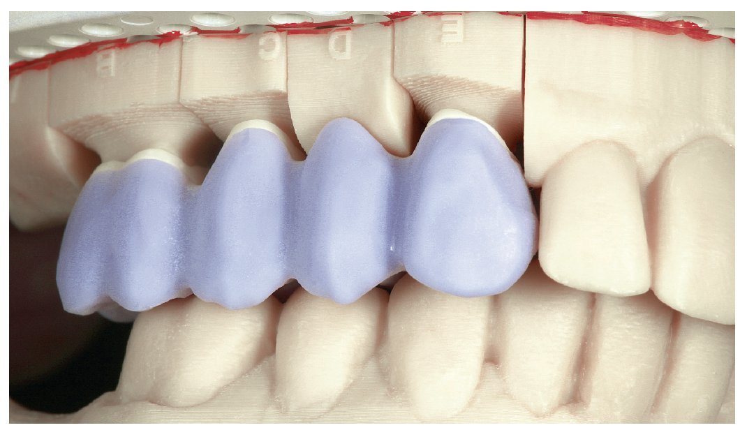 Recubrimiento digital de coronas y estructuras de puentes ...