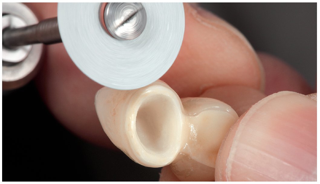 Recubrimiento digital de coronas y estructuras de puentes ...