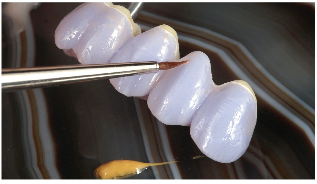 Recubrimiento digital de coronas y estructuras de puentes ...