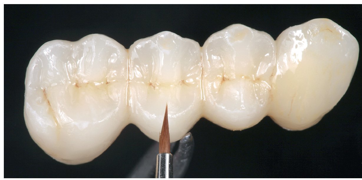 Recubrimiento digital de coronas y estructuras de puentes ...