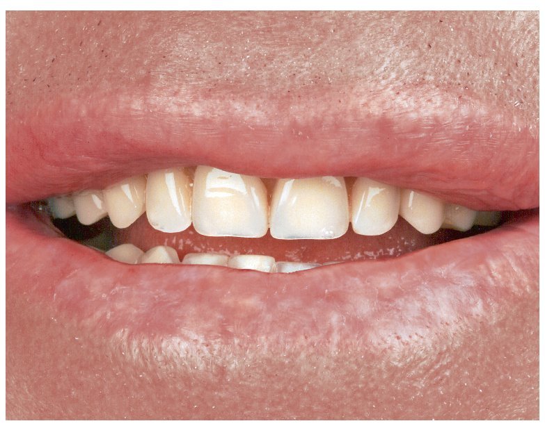 Rehabilitación de un paciente edéntulo mediante puentes ...