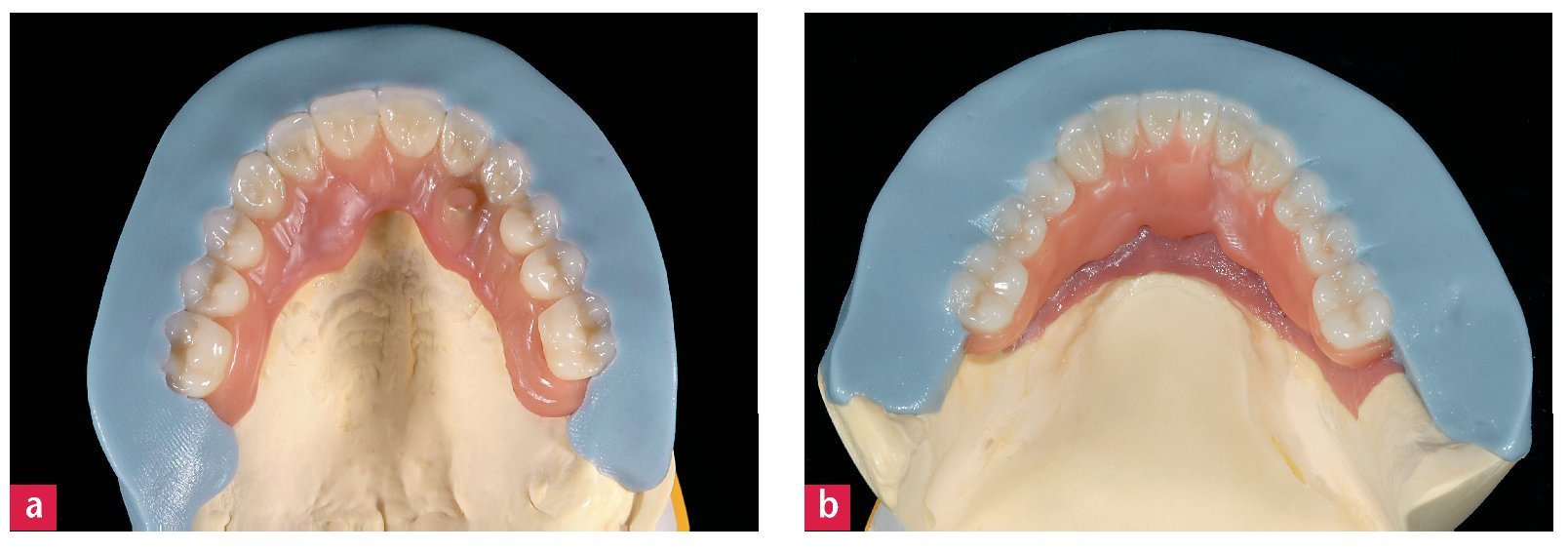 Rehabilitación de un paciente edéntulo mediante puentes ...