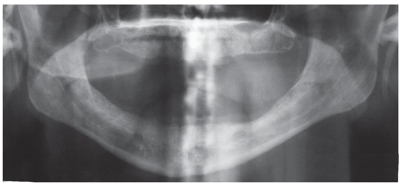 Rehabilitación de un paciente edéntulo mediante puentes ...