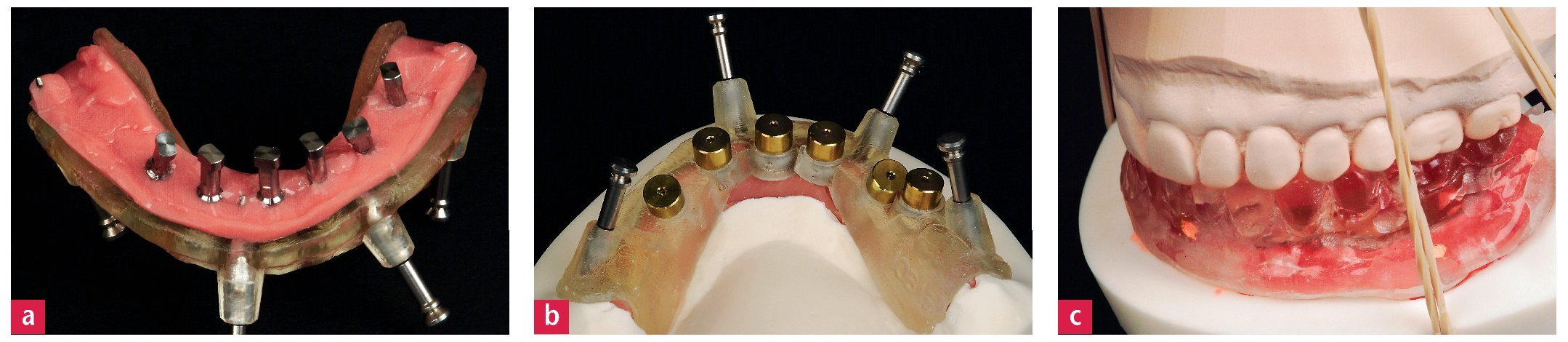 Rehabilitación de un paciente edéntulo mediante puentes ...