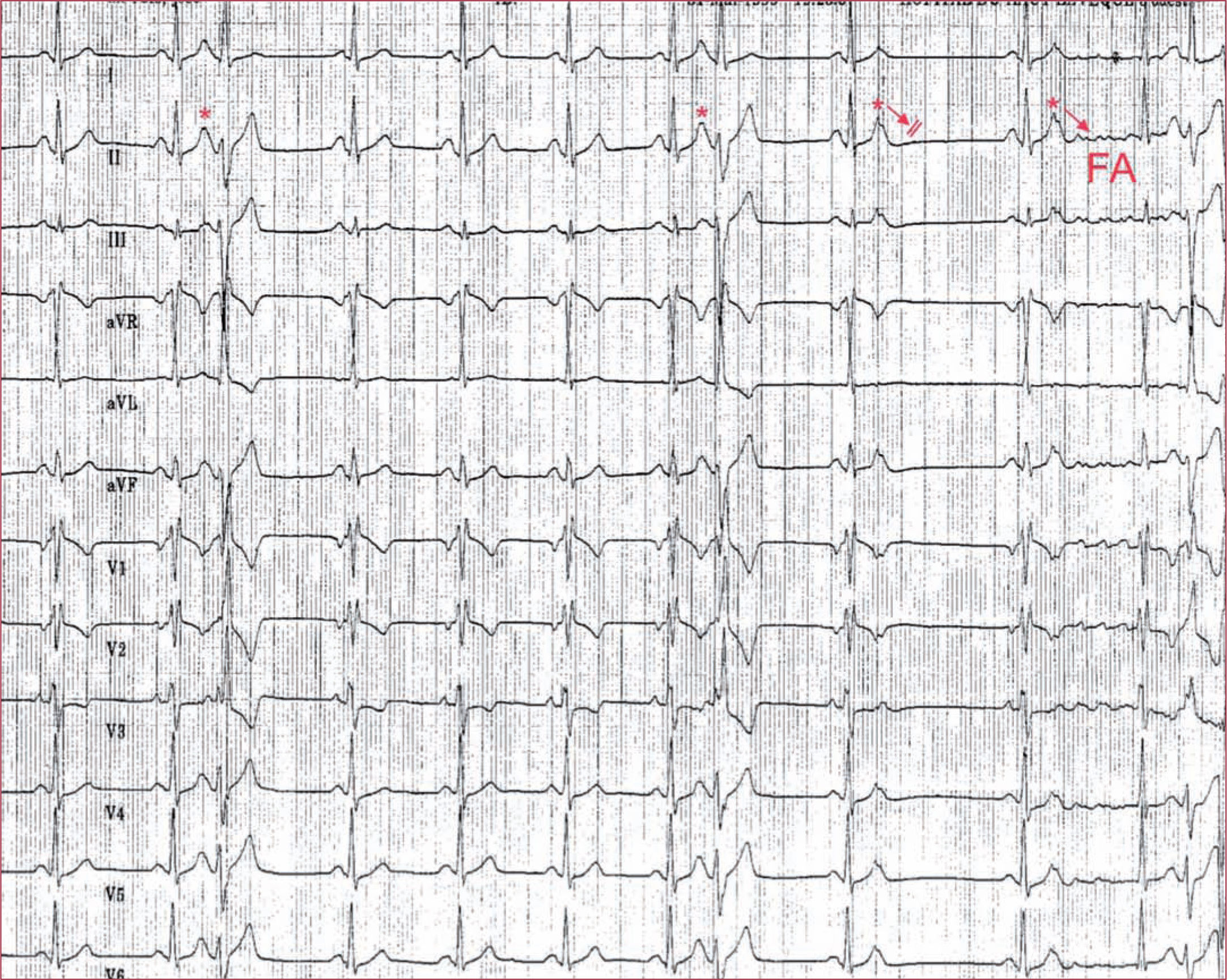 Mecanismos electrofisiológicos y diagnóstico de la fibrilación ...