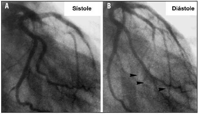 Miocardiopatía hipertrófica. Bases genéticas e implicaciones clínicas ...