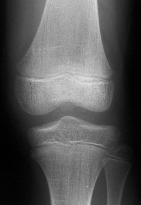 Fijación interna de avulsión de espina tibial en niños | Técnicas ...