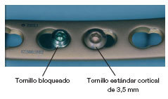 Fijación interna para fracturas de húmero proximal utilizando la placa ...