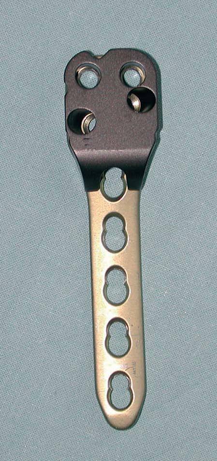 Fijación interna para fracturas de húmero proximal utilizando la placa ...