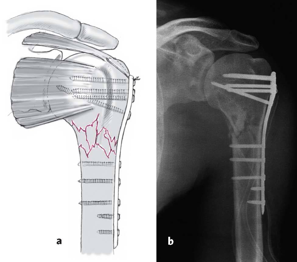 Fijación interna para fracturas de húmero proximal utilizando la placa ...