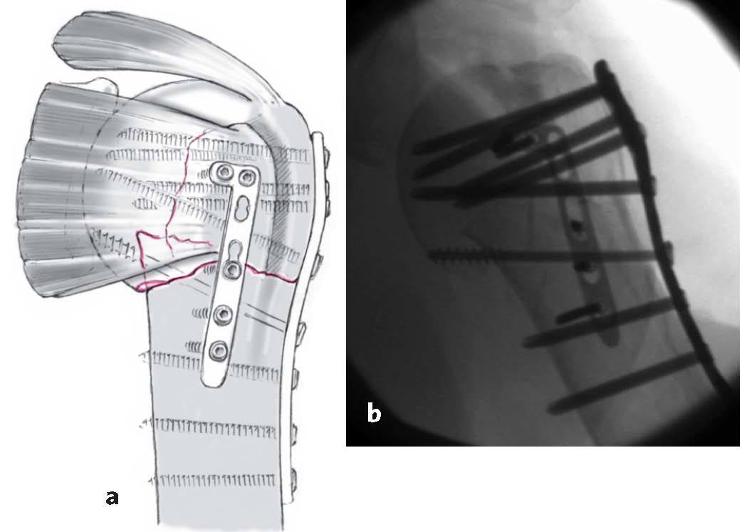 Fijación interna para fracturas de húmero proximal utilizando la placa ...