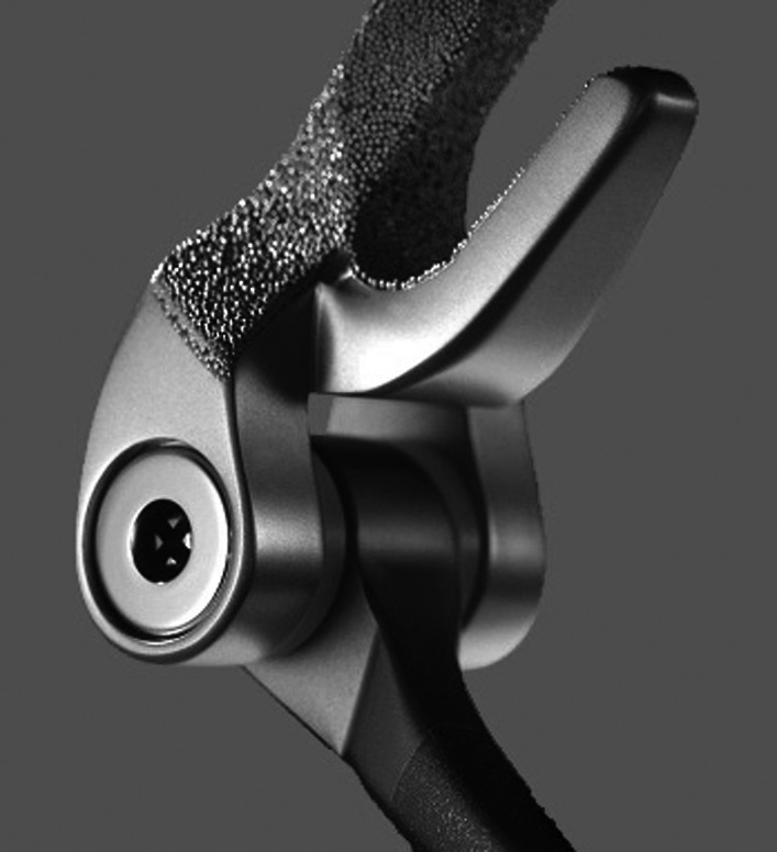 Prótesis total de codo primaria en fracturas del húmero distal ...