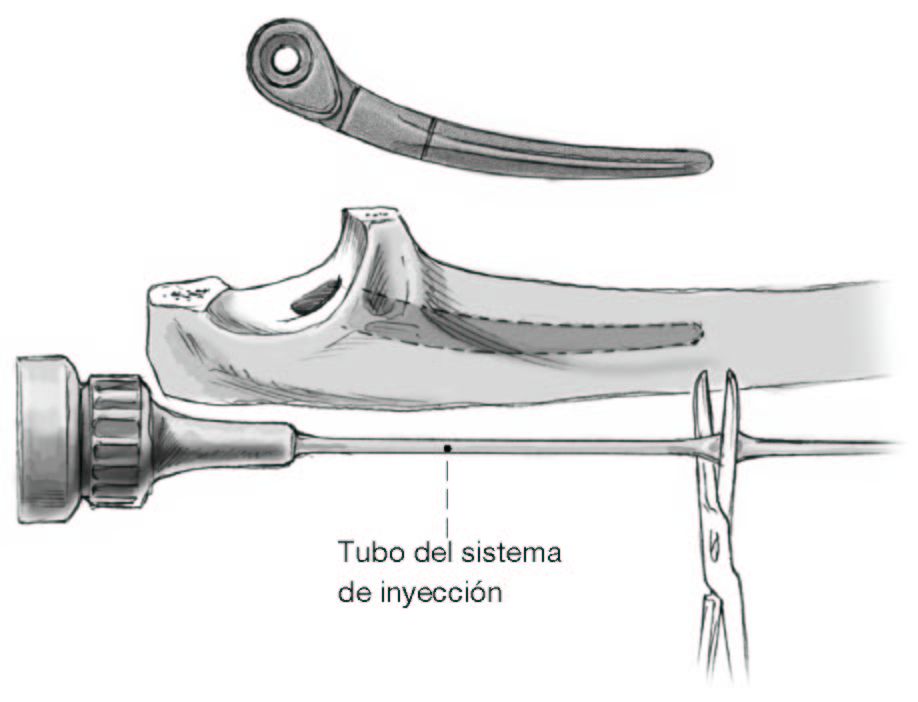 Prótesis total de codo primaria en fracturas del húmero distal ...
