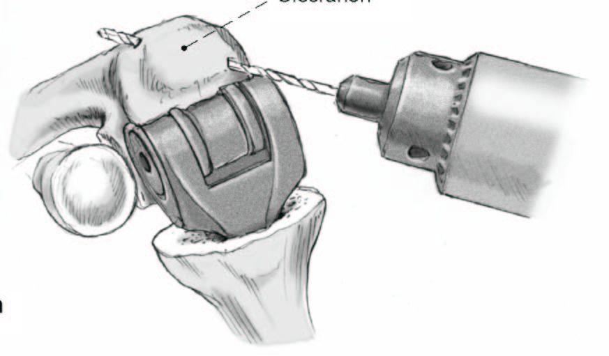 Prótesis total de codo primaria en fracturas del húmero distal ...