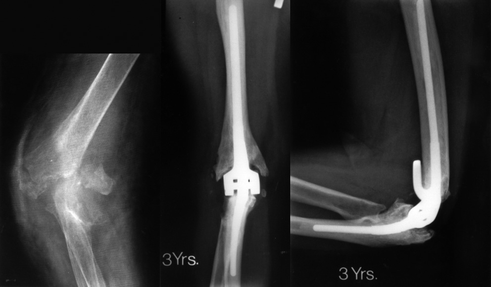Prótesis total de codo primaria en fracturas del húmero distal ...