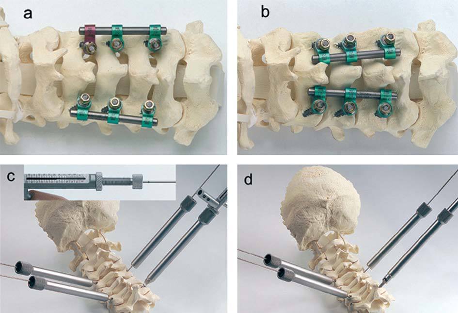 Instrumentación dorsal de la columna cervical con el nuevo sistema ...
