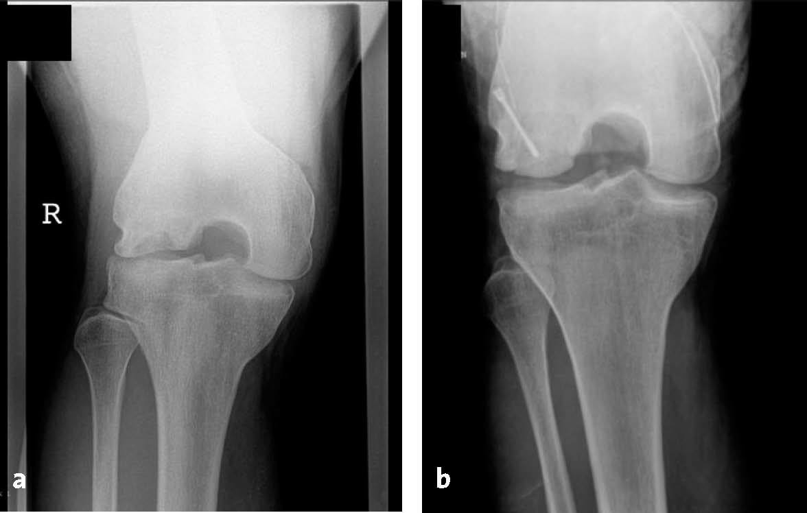 Utilización de aloinjertos recientes en la osteocondrosis disecante del ...